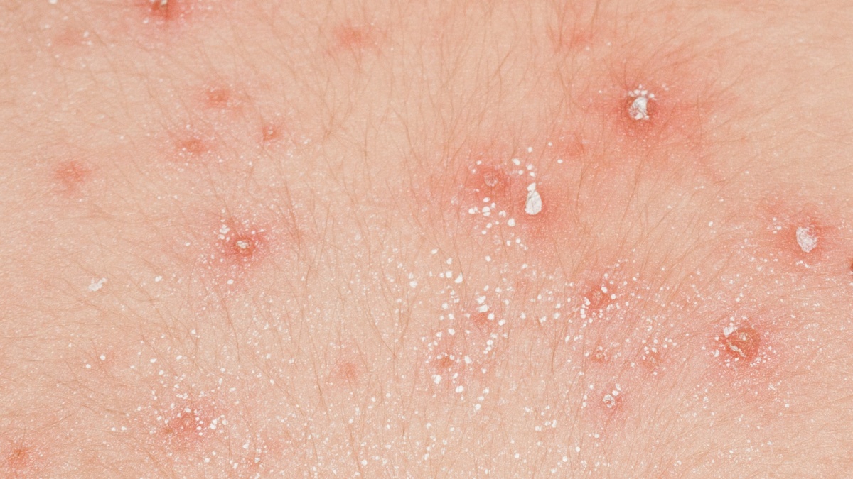 Vokietijoje patvirtintas pirmasis beždžionių raupų atvejis - Gyvenu.de