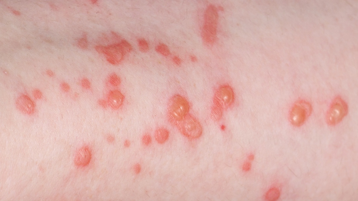 Vokietijoje pirmą kartą beždžionių raupai nustatyti vaikui - Gyvenu.de